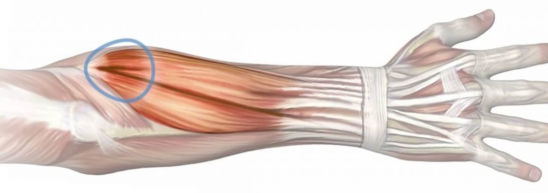Tennis Elbow or Lateral Epicondylitis - What is it and how should I ...